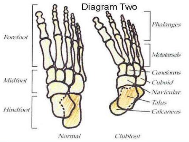Idiopathic club foot
