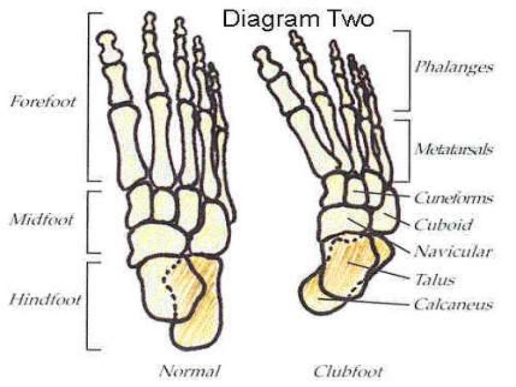 Idiopathic club foot