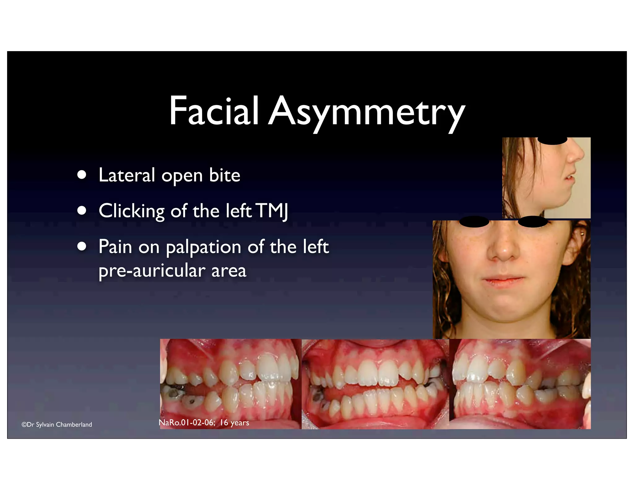 Idiopathic condylar resorption and arthrosis of the joints | PDF