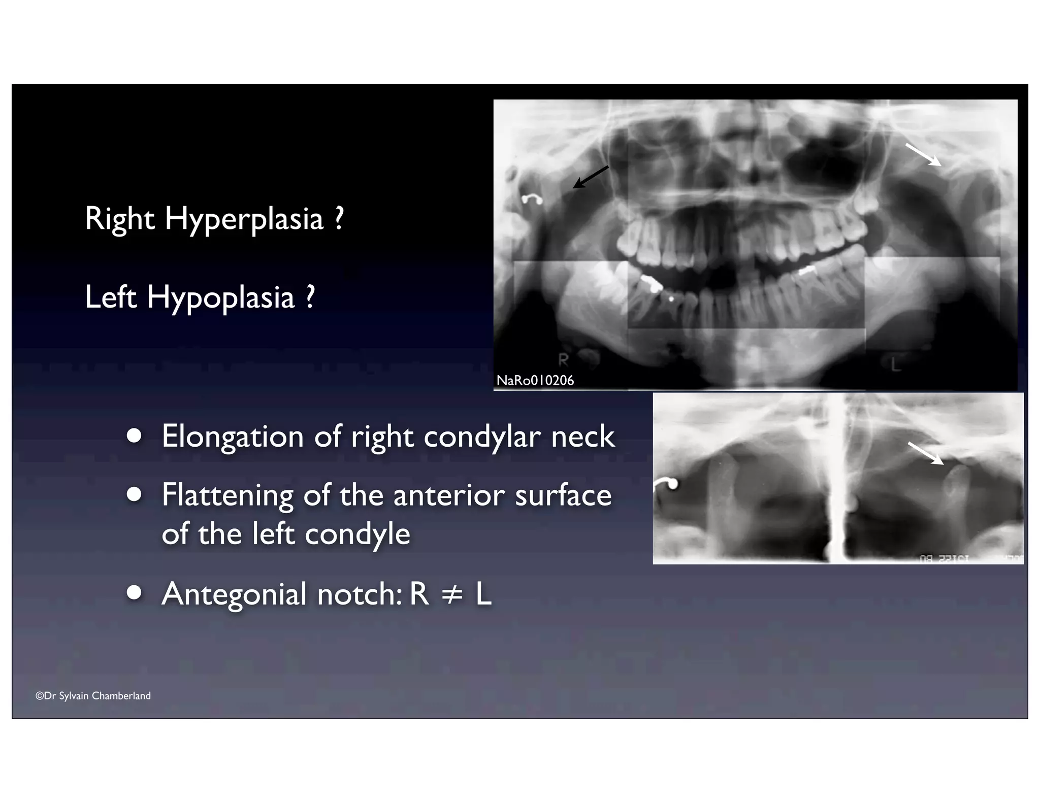 Idiopathic condylar resorption and arthrosis of the joints | PDF