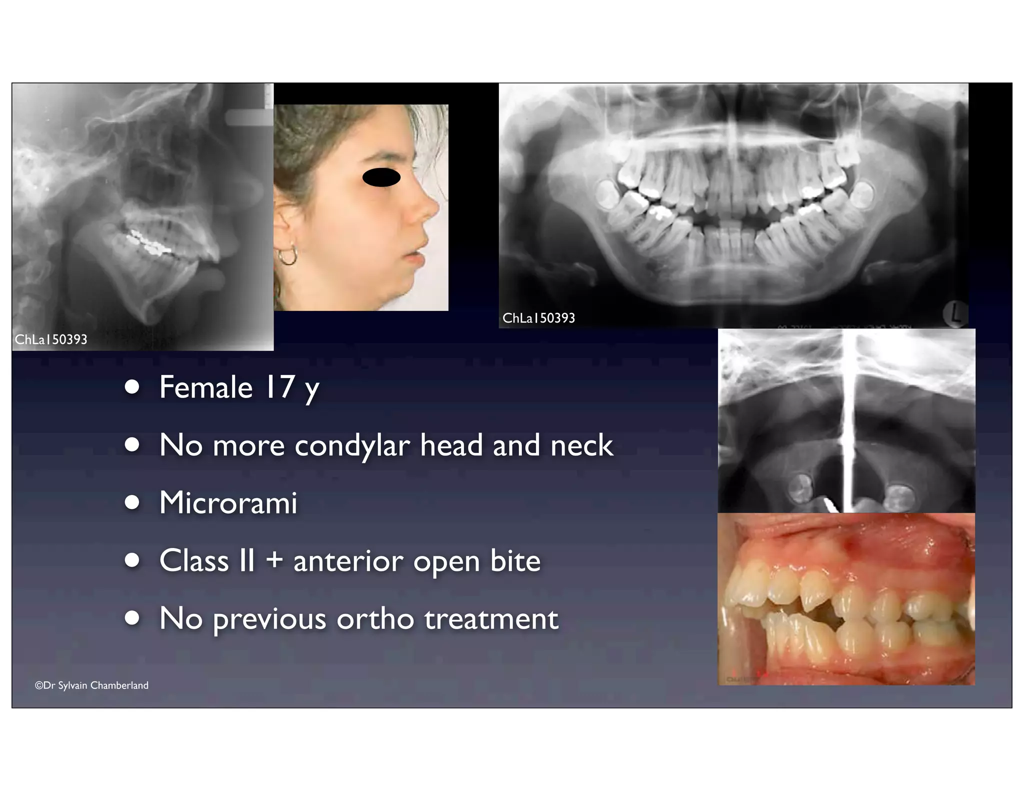 Idiopathic condylar resorption and arthrosis of the joints | PDF