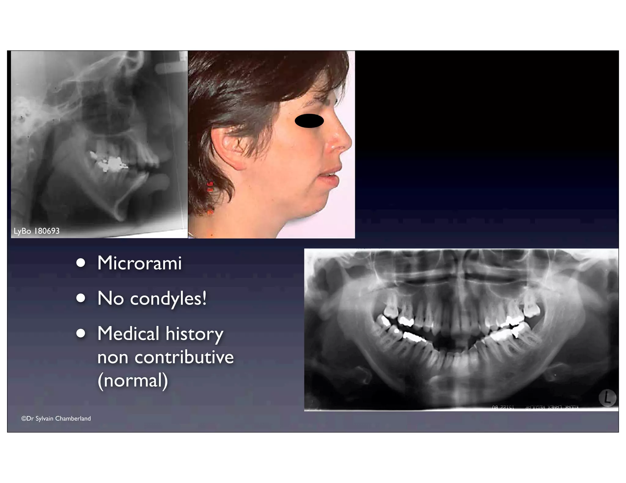 Idiopathic condylar resorption and arthrosis of the joints | PDF
