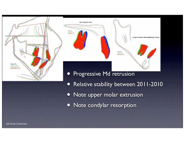 Idiopathic Condylar Resorption And Arthrosis Of The Joints