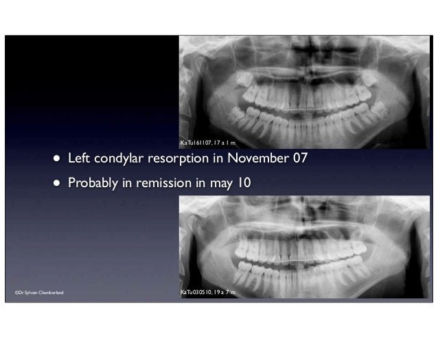 Idiopathic condylar resorption and arthrosis of the joints