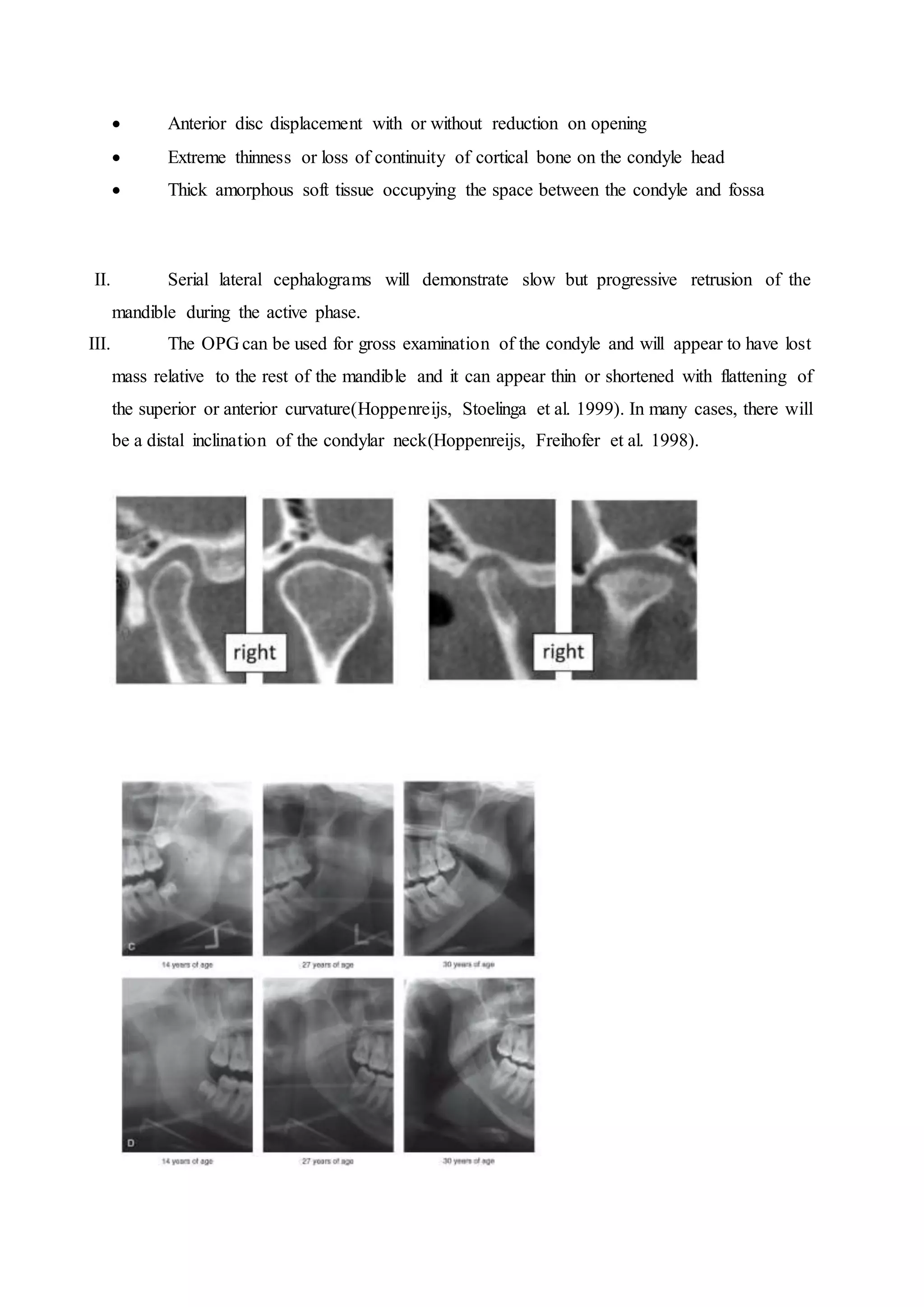 Idiopathic condylar resorption and its impact on orthodontic treatment ...