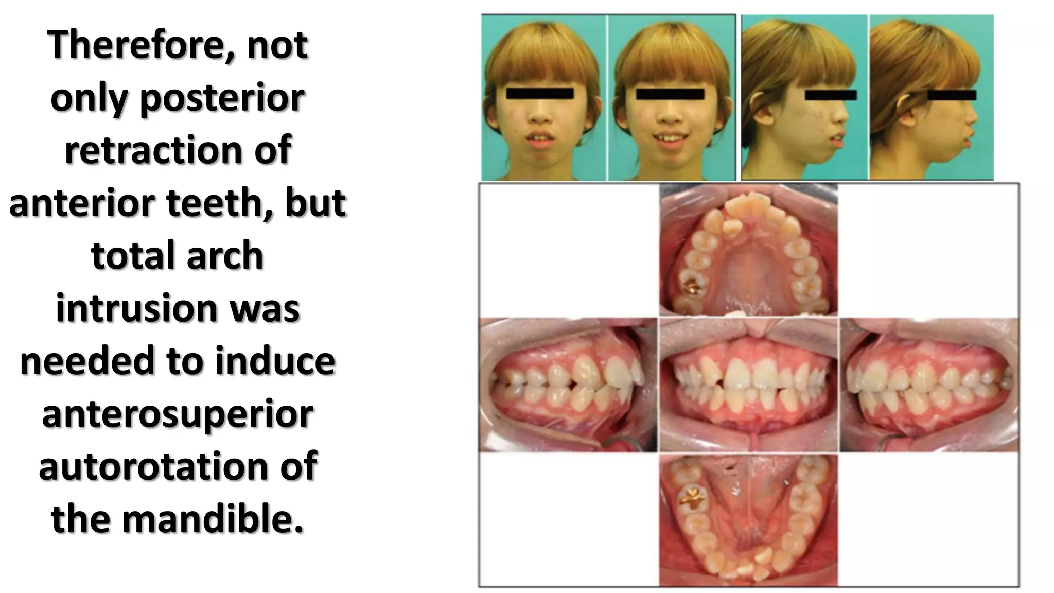 orthodontic management of Idiopathic condylar resorption part 2 | PPT