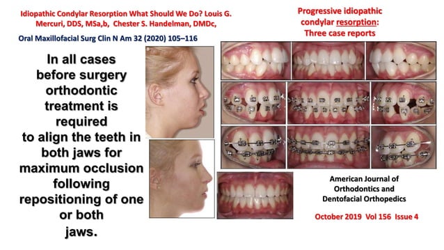 orthodontic management of Idiopathic condylar resorption part 2 | PPT