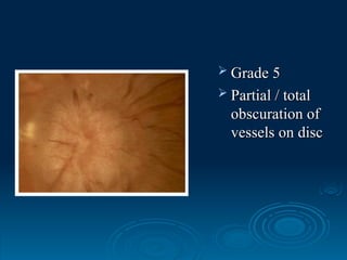 Idiopathic Intracranial Hypertension.ppt