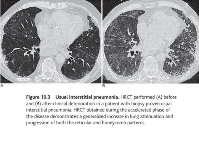 Idiopathic Interstitial Pneumonias.pptx