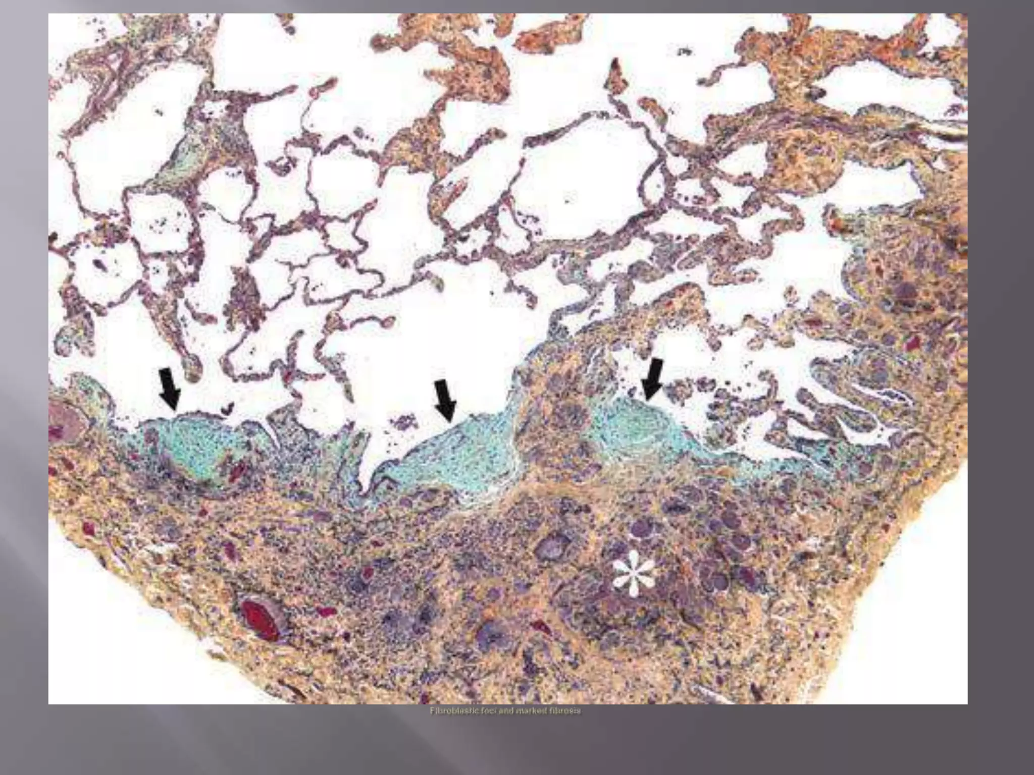 Idiopathic interstitial pneumonias 1 | PPTX