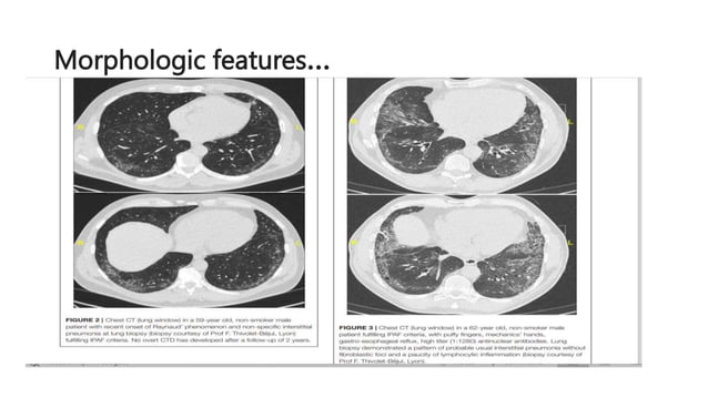 Idiopathic Interstitial Pneumonia With Autoimmune Features(IPAF).pptx