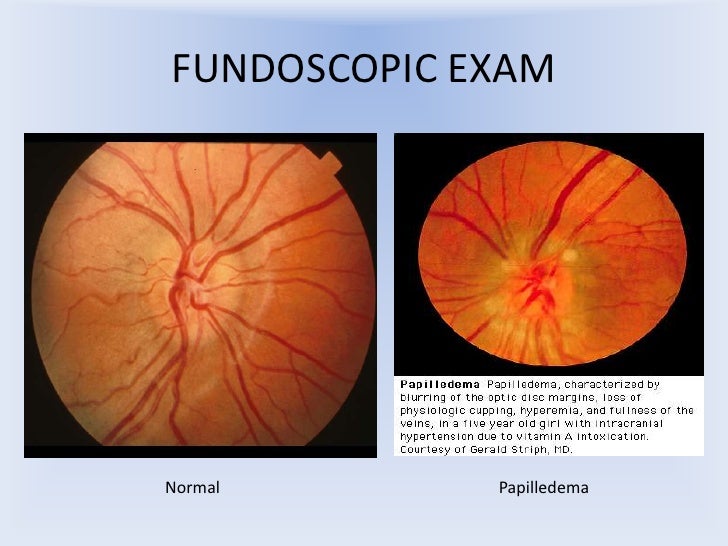 Idiopathic Intracranial Hypertension