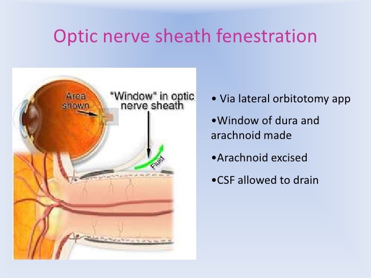 Idiopathic Intracranial Hypertension