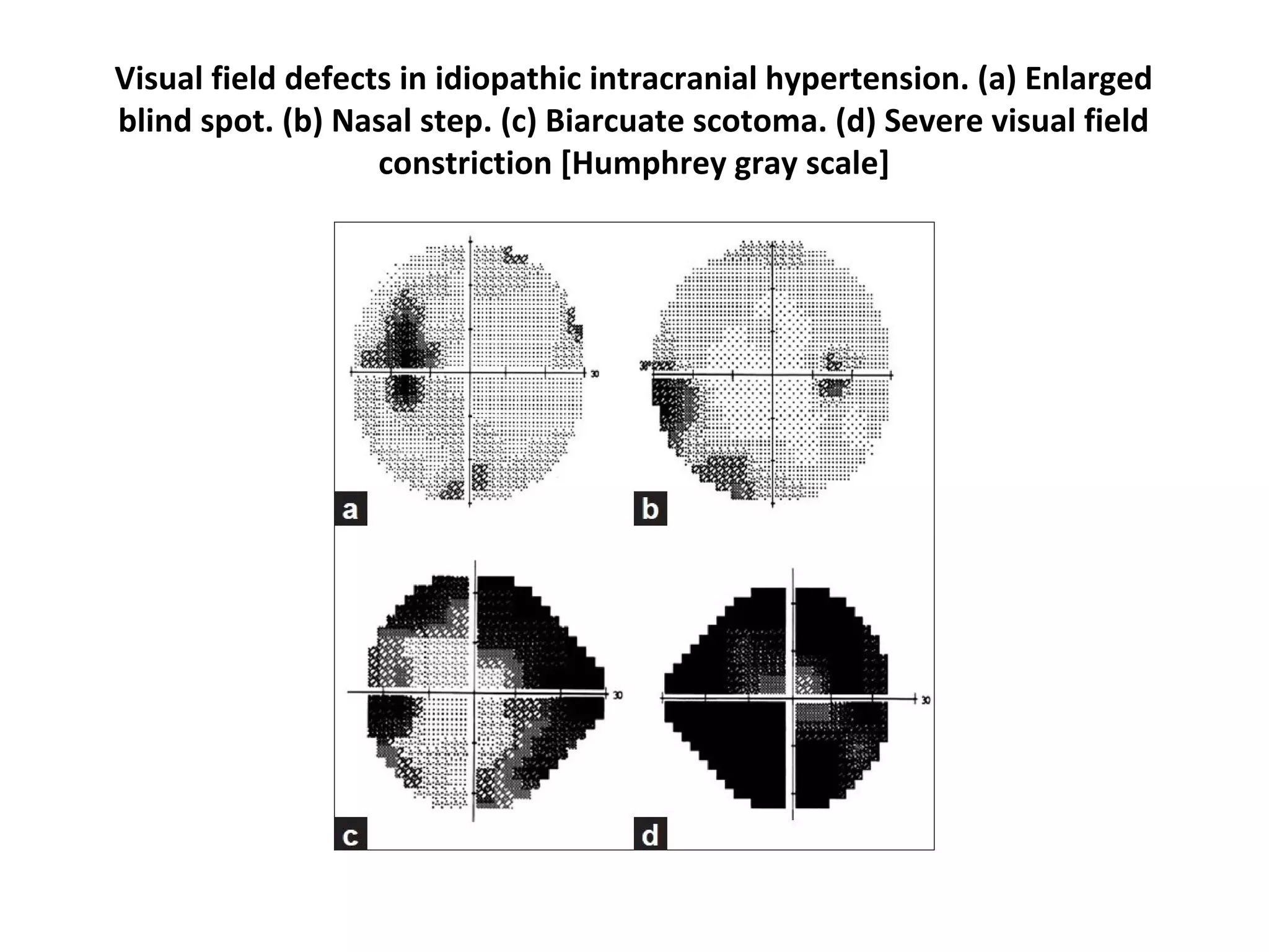 Idiopathic intracranial hypertension | PPT