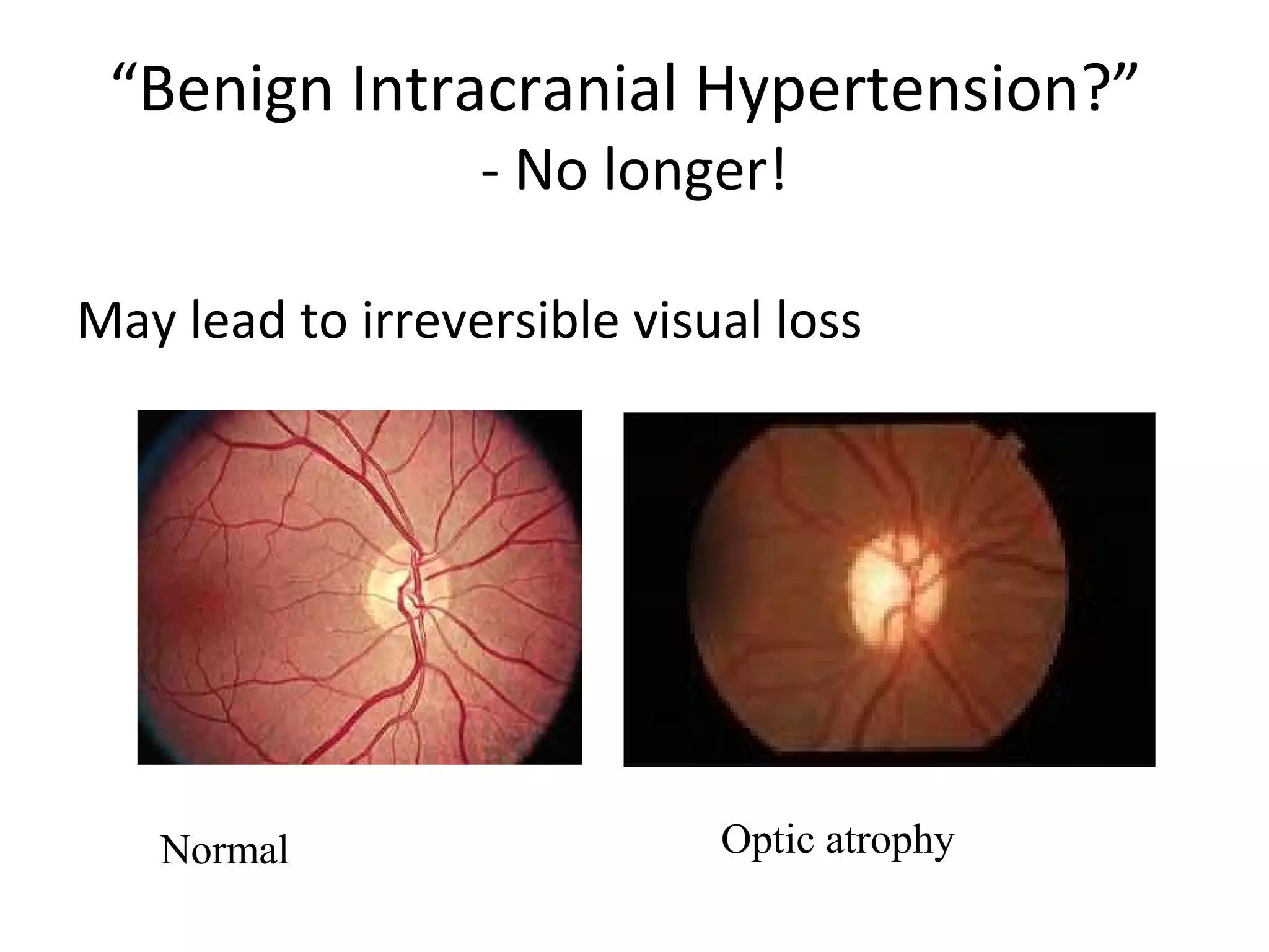 Idiopathic intracranial hypertension | PPT