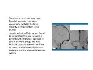 Idiopathic intracranial hypertension | PPT