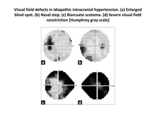 Idiopathic intracranial hypertension | PPT