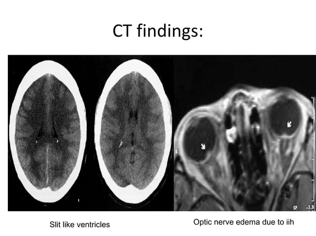 Idiopathic intracranial hypertension | PPT