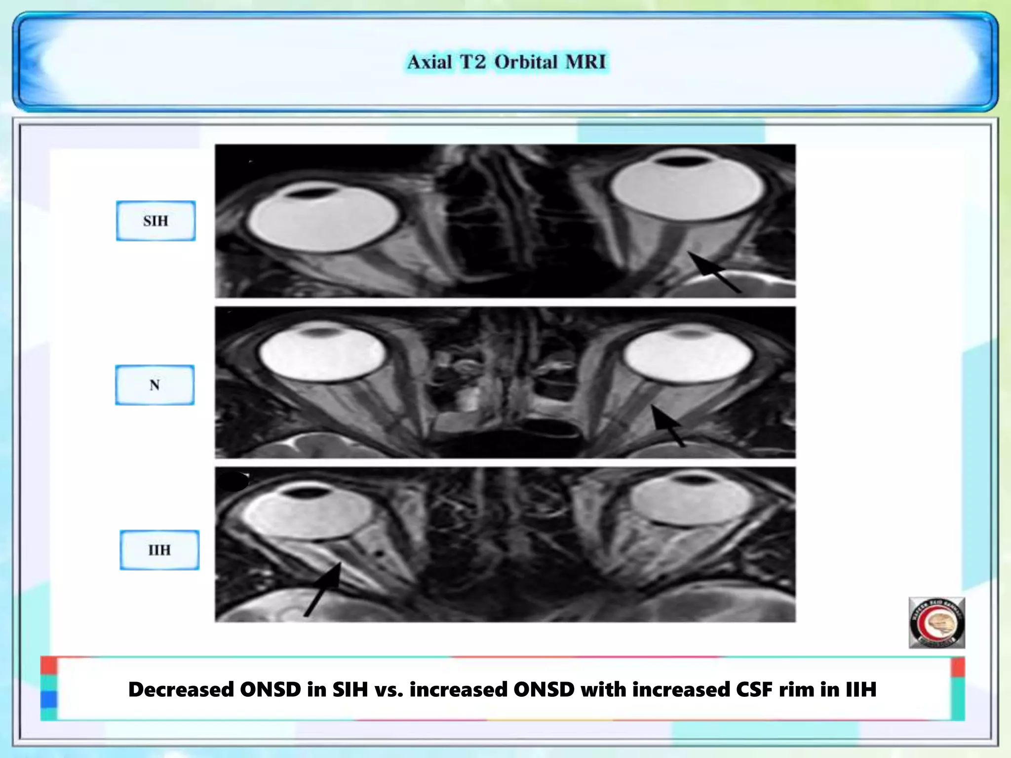 Idiopathic intracranial hypertension, Looking for the black cat in the ...