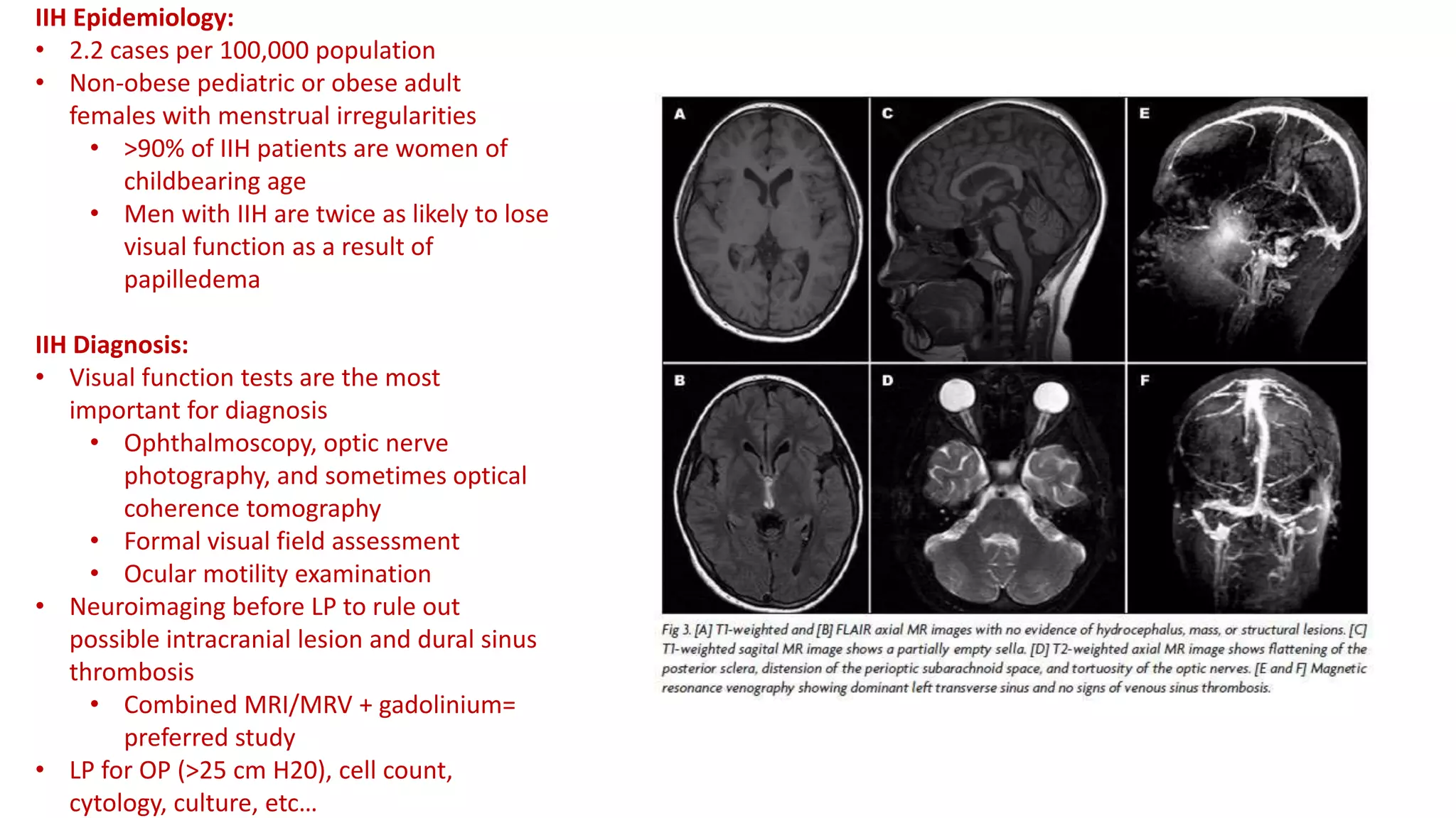 Idiopathic intracranial hypertension (pseudotumor cerebri) | PPTX