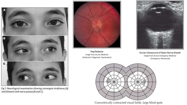Idiopathic intracranial hypertension (pseudotumor cerebri) | PPTX | Ear ...