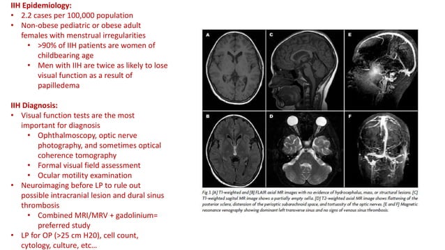 Idiopathic intracranial hypertension (pseudotumor cerebri) | PPTX | Ear ...