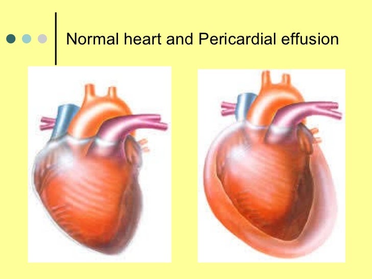 Idiopathic pericardial effusion in dogs