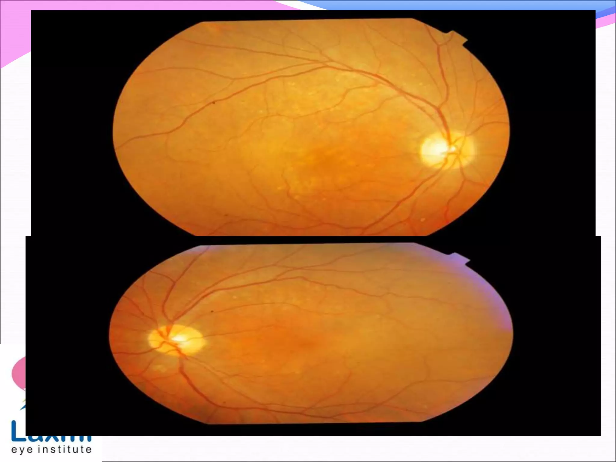 Idiopathic polypoidal choroidal vasculopathy | PPTX