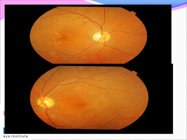 Idiopathic polypoidal choroidal vasculopathy | PPTX