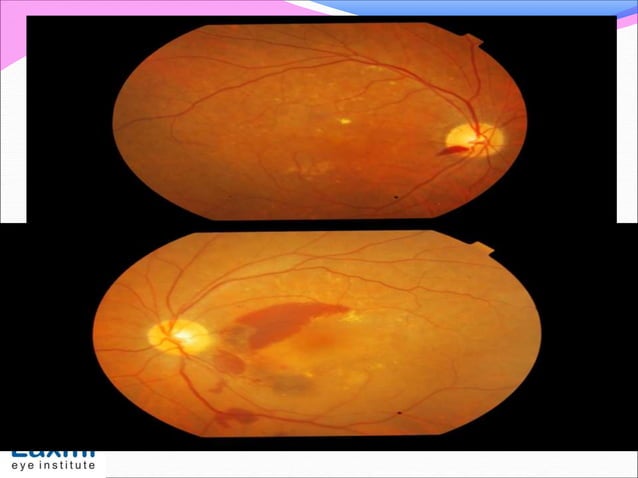 Idiopathic polypoidal choroidal vasculopathy | PPTX