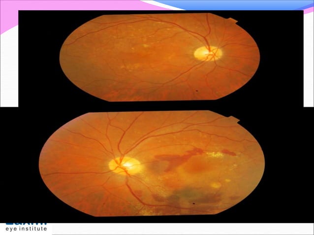 Idiopathic polypoidal choroidal vasculopathy | PPTX