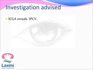 Idiopathic polypoidal choroidal vasculopathy | PPTX