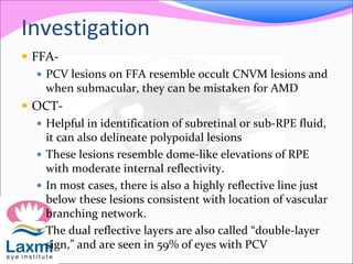 Idiopathic polypoidal choroidal vasculopathy | PPTX
