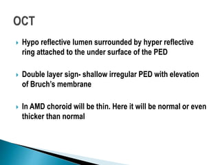 Idiopathic polypoidal choroidal vasculopathy | PPTX