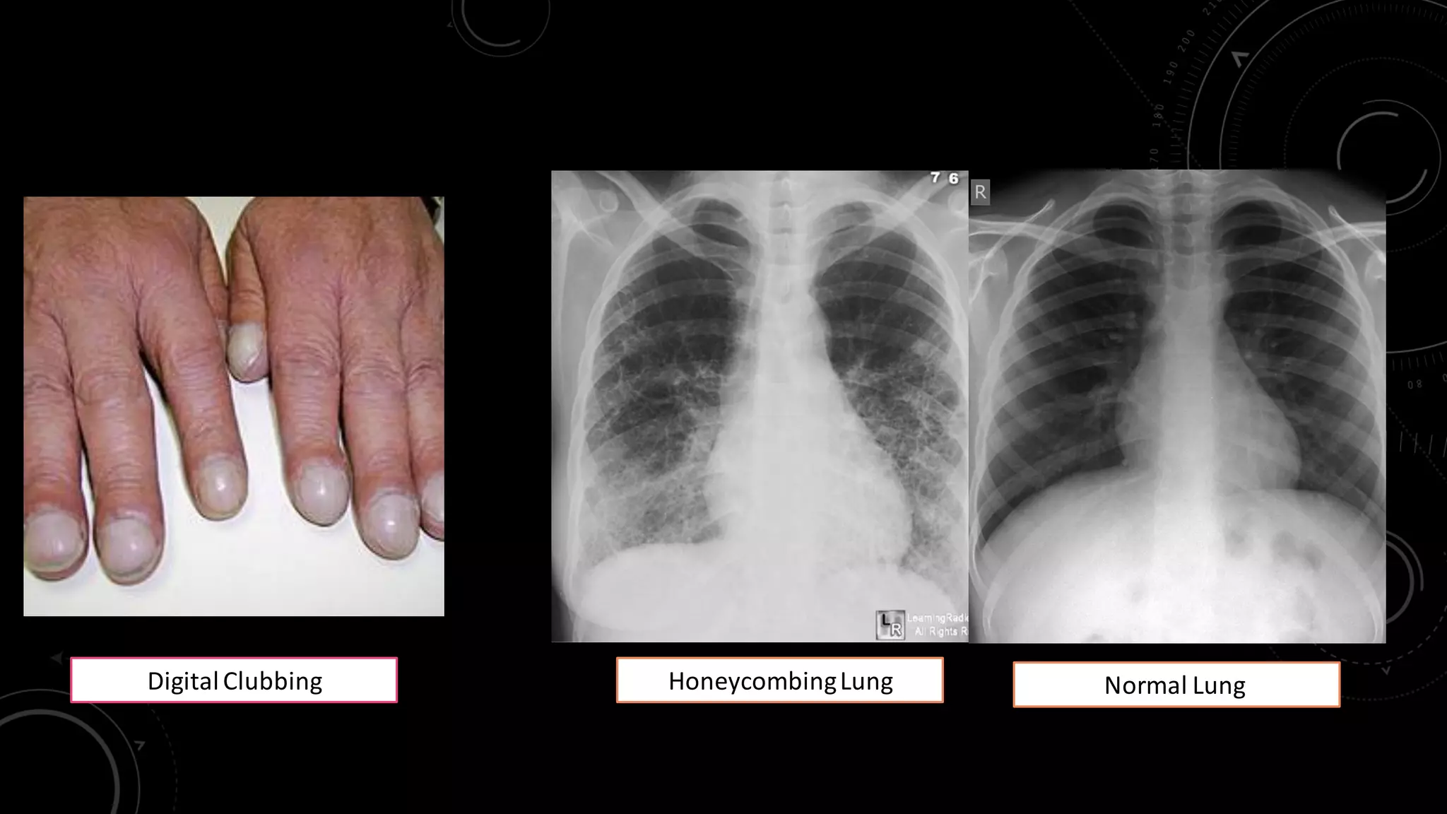 Idiopathic pulmonary fibrosis 101 | PPT