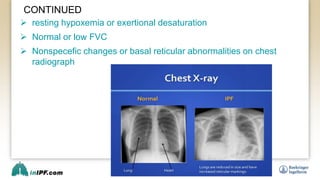 Idiopathic pulmonary fibrosis | PPTX