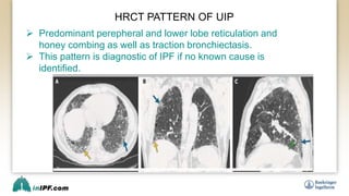 Idiopathic pulmonary fibrosis | PPTX