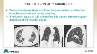 Idiopathic pulmonary fibrosis | PPTX