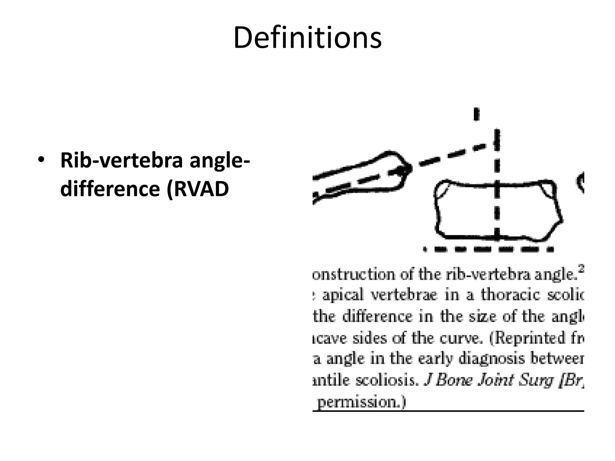 Idiopathic scoliosis | PPT