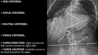 IDIOPATHIC SCOLIOSIS INTRODUCTION DIAGNOSIS TREATMENT | PPT