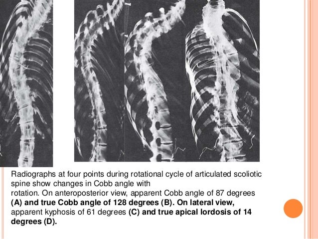Idiopathic scoliosisis