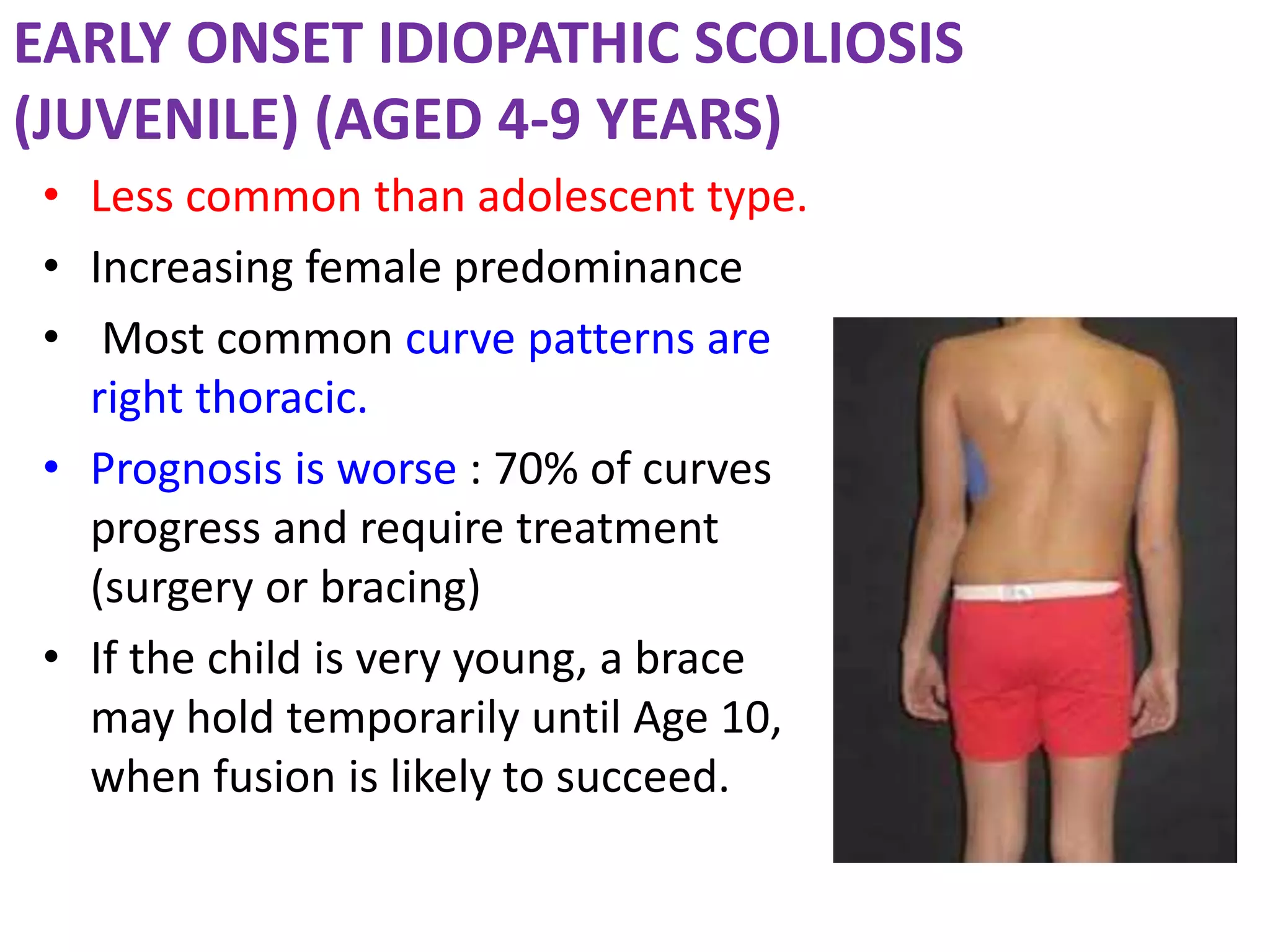 Idiopathic scoliosis | PPTX