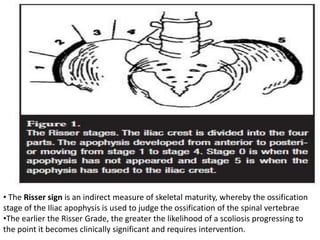 Idiopathic scoliosis | PPTX