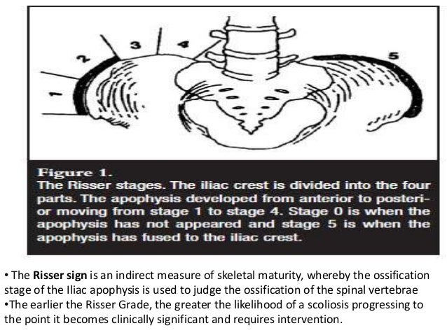 Idiopathic scoliosis