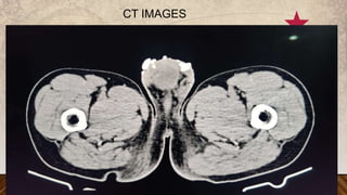 IDIOPATHIC SCROTAL CALCINOSIS.pptx