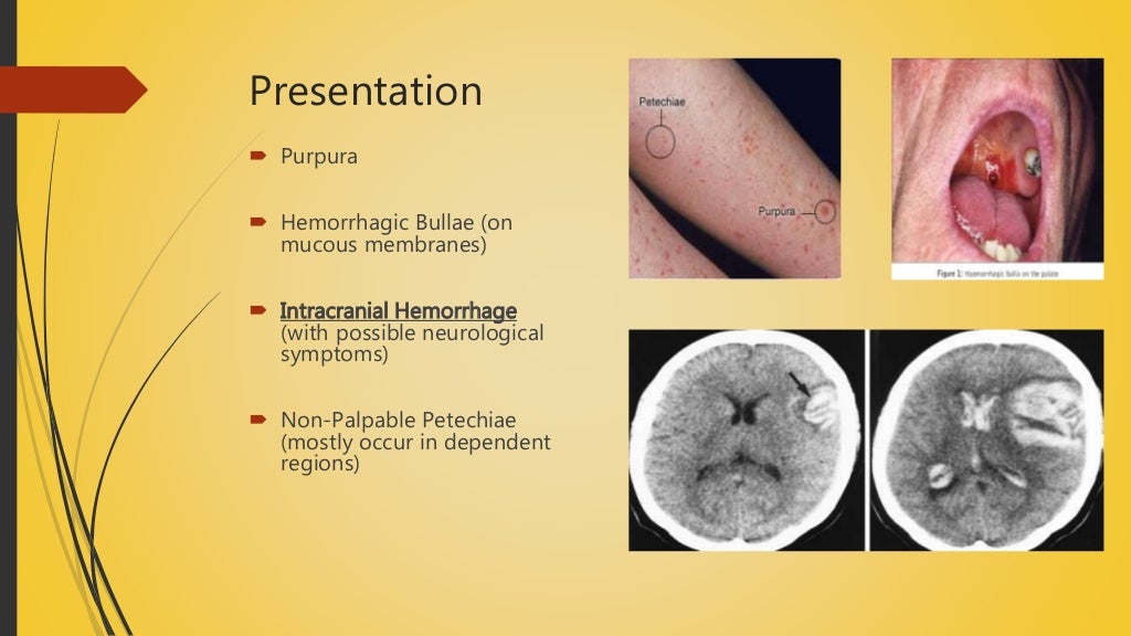 Idiopathic Thrombocytopenic Purpura