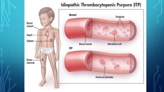 Idiopathic thrombocytopenic purpura | PPTX