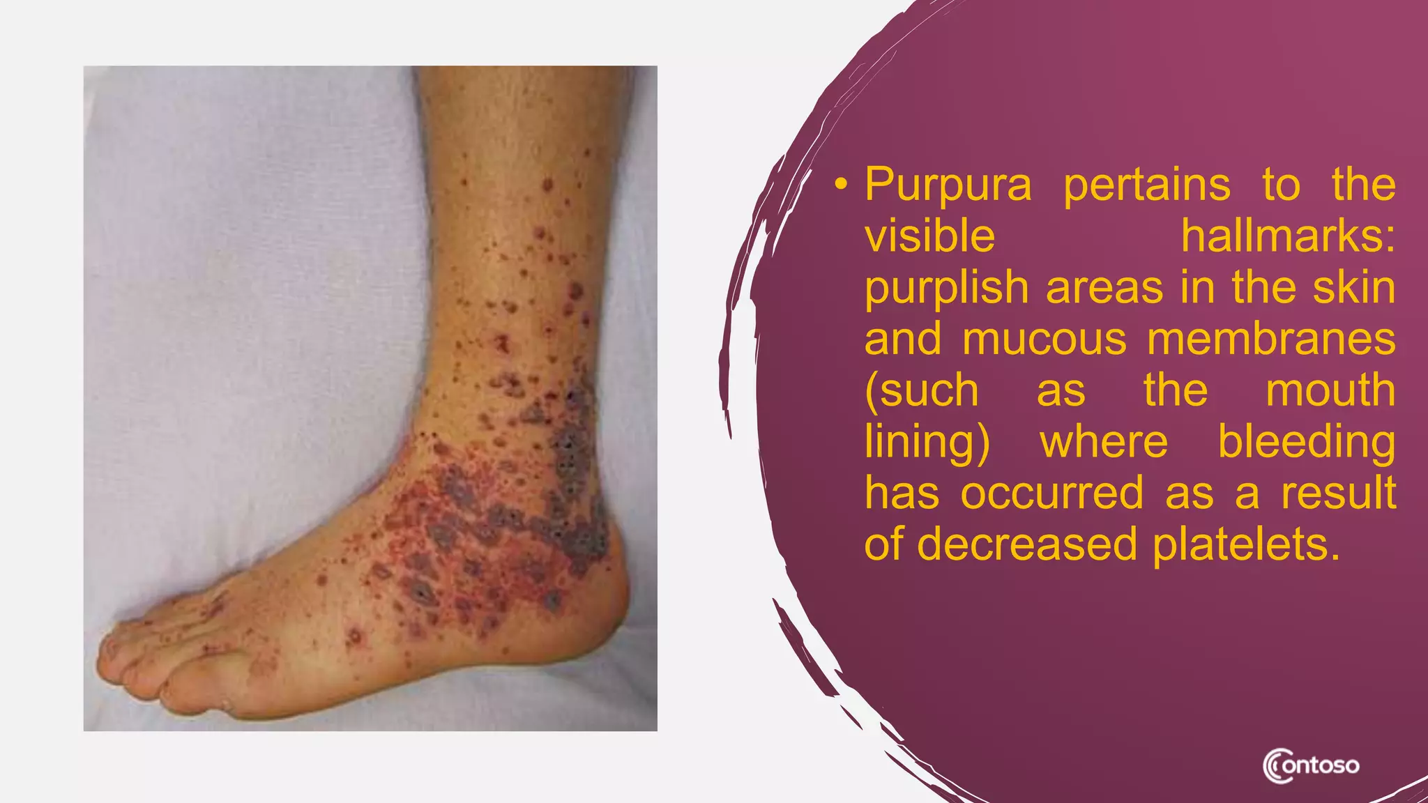 Idiopathic thrombocytopenic purpura | PPTX