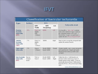 Idiopathic ventricular tachycardia | PPT