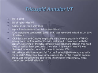 Idiopathic ventricular tachycardia | PPT
